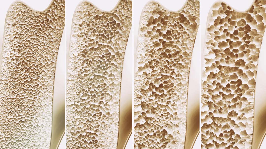 Calcium and Vitamin D Supplements DO NOT Prevent Fractures in Older ...